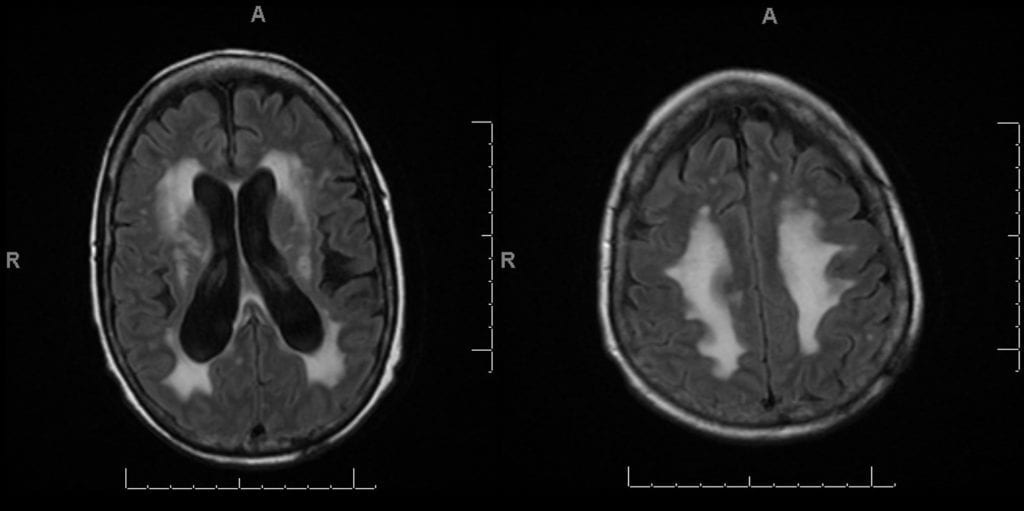 Demyelinating Disease Review and Quiz | NowYouKnow Neuro