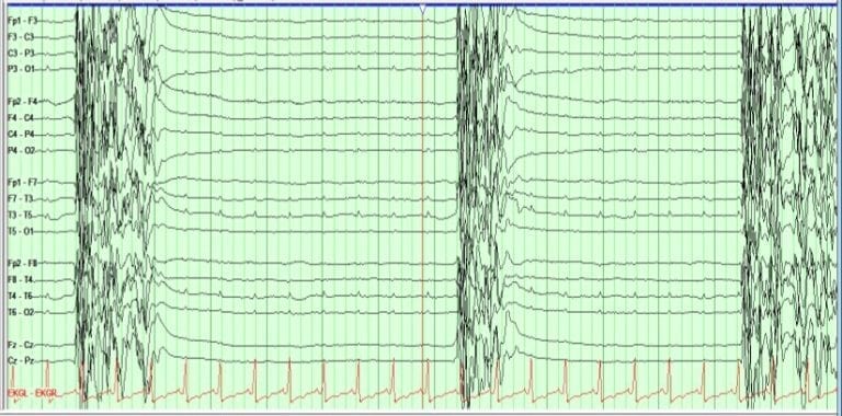 Learn to Read EEG , with practice questions! | NowYouKnow Neuro