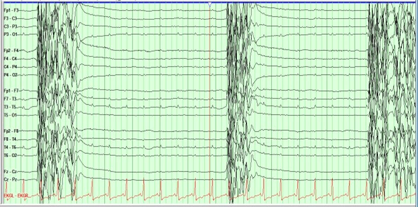 Learn to Read EEG , with practice questions! | NowYouKnow Neuro