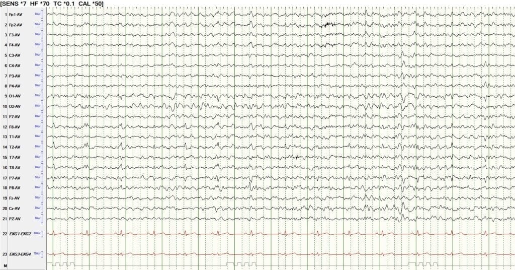 Learn to Read EEG , with practice questions! | NowYouKnow Neuro