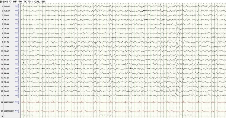 Learn to Read EEG , with practice questions! | NowYouKnow Neuro