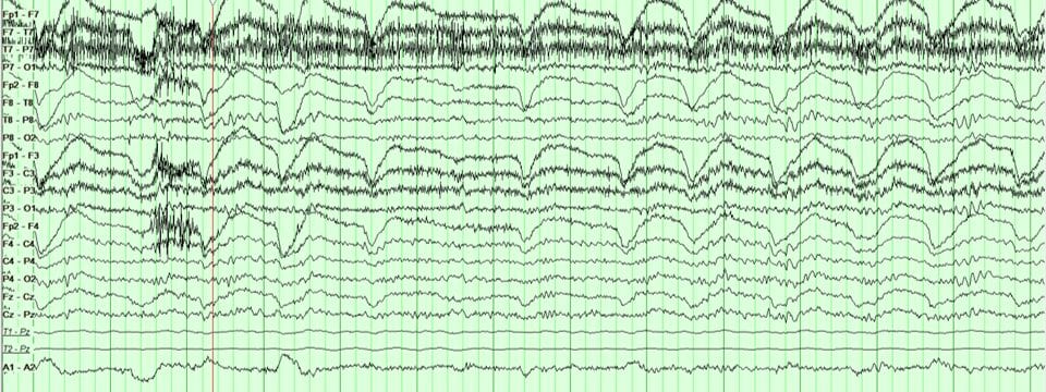 Learn to Read EEG , with practice questions! | NowYouKnow Neuro