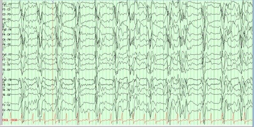 Learn to Read EEG , with practice questions! | NowYouKnow Neuro