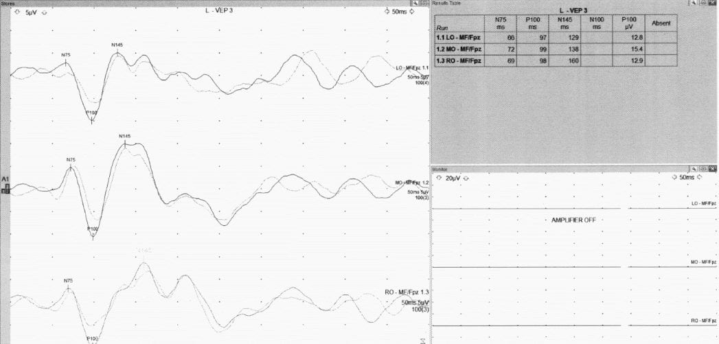 Evoked Potentials | NowYouKnow Neuro
