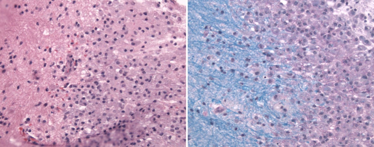 Demyelinating Disease Review and Quiz | NowYouKnow Neuro