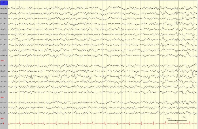 Learn to Read EEG , with practice questions! | NowYouKnow Neuro