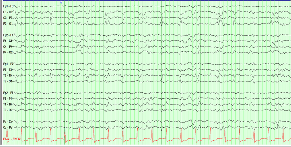 Learn to Read EEG , with practice questions! | NowYouKnow Neuro