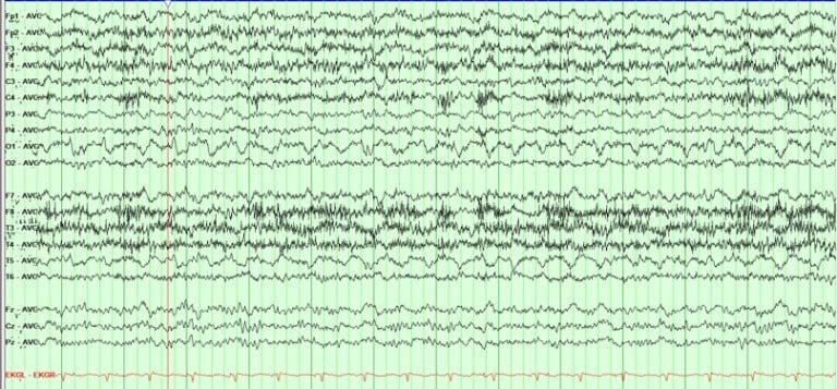 Learn to Read EEG , with practice questions! | NowYouKnow Neuro