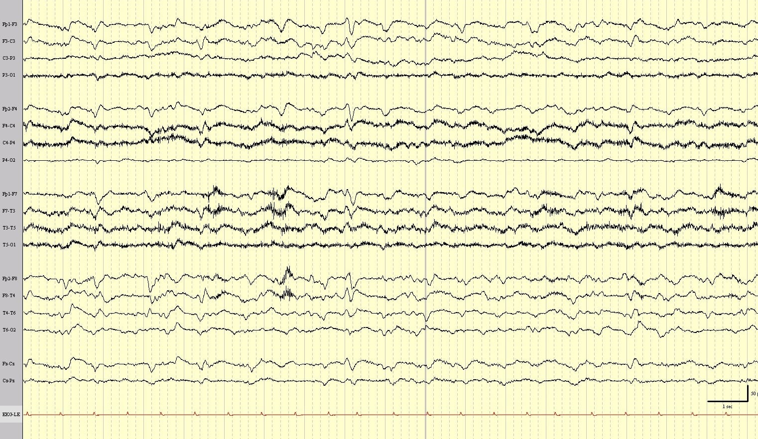 Learn to Read EEG , with practice questions! | NowYouKnow Neuro