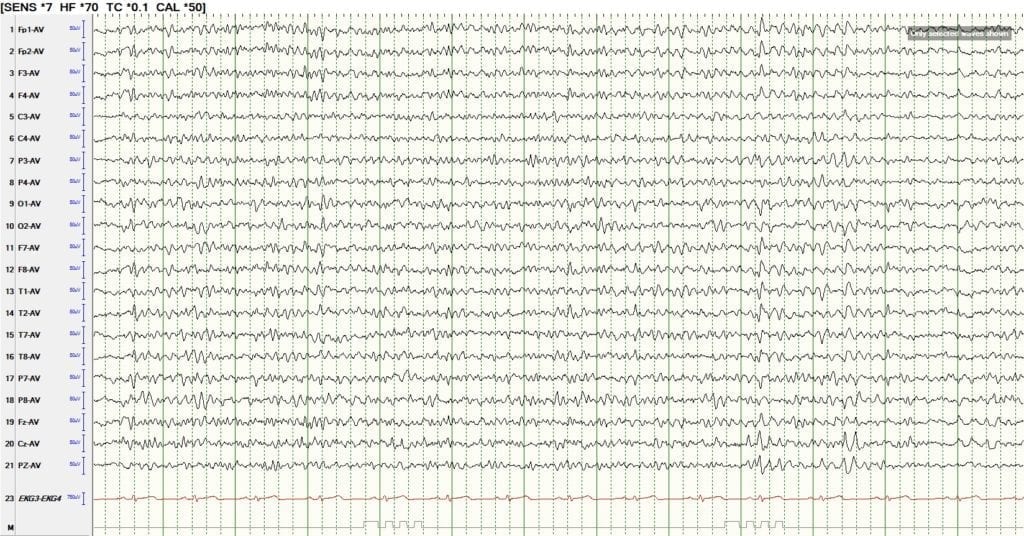Learn to Read EEG , with practice questions! | NowYouKnow Neuro