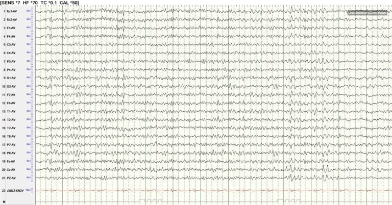 Learn to Read EEG , with practice questions! | NowYouKnow Neuro