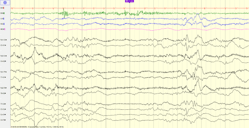 Learn to Read EEG , with practice questions! | NowYouKnow Neuro