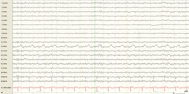 Learn to Read EEG , with practice questions! | NowYouKnow Neuro