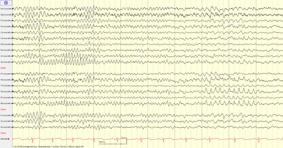 Learn to Read EEG , with practice questions! | NowYouKnow Neuro