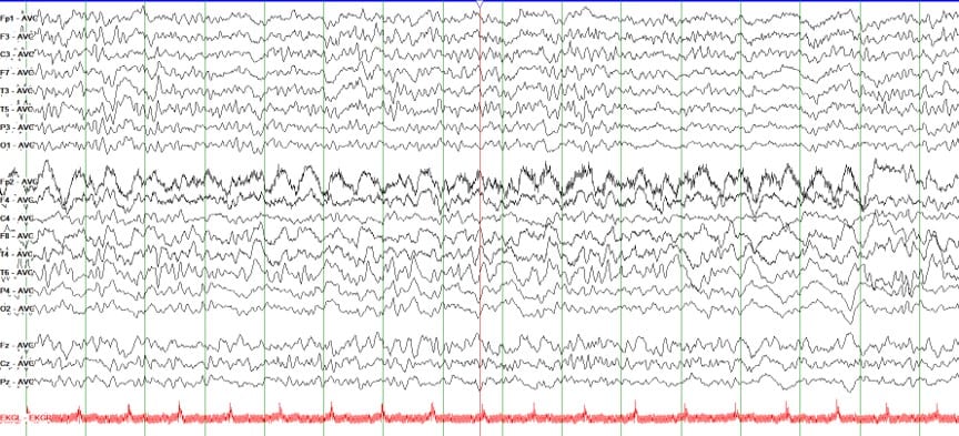 Learn to Read EEG , with practice questions! | NowYouKnow Neuro