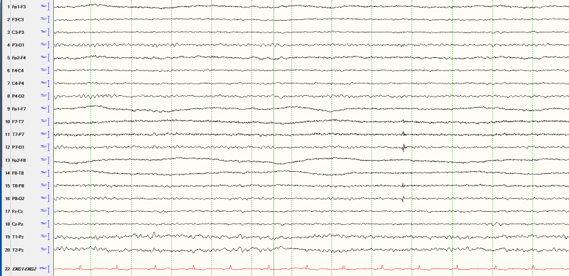 Learn to Read EEG , with practice questions! | NowYouKnow Neuro