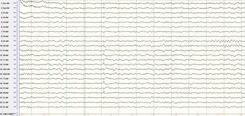 Learn to Read EEG , with practice questions! | NowYouKnow Neuro