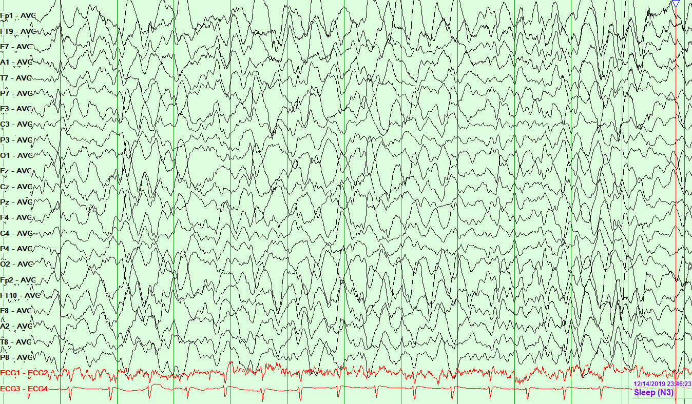 Sleep Disorders Neuro Review | Chapter and Quiz | NowYouKnow Neuro