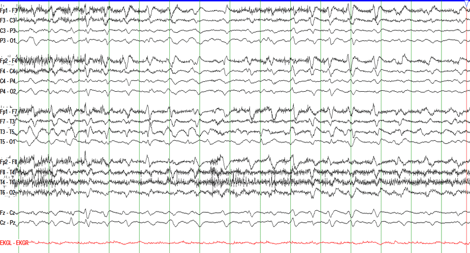 Learn to Read EEG , with practice questions! | NowYouKnow Neuro