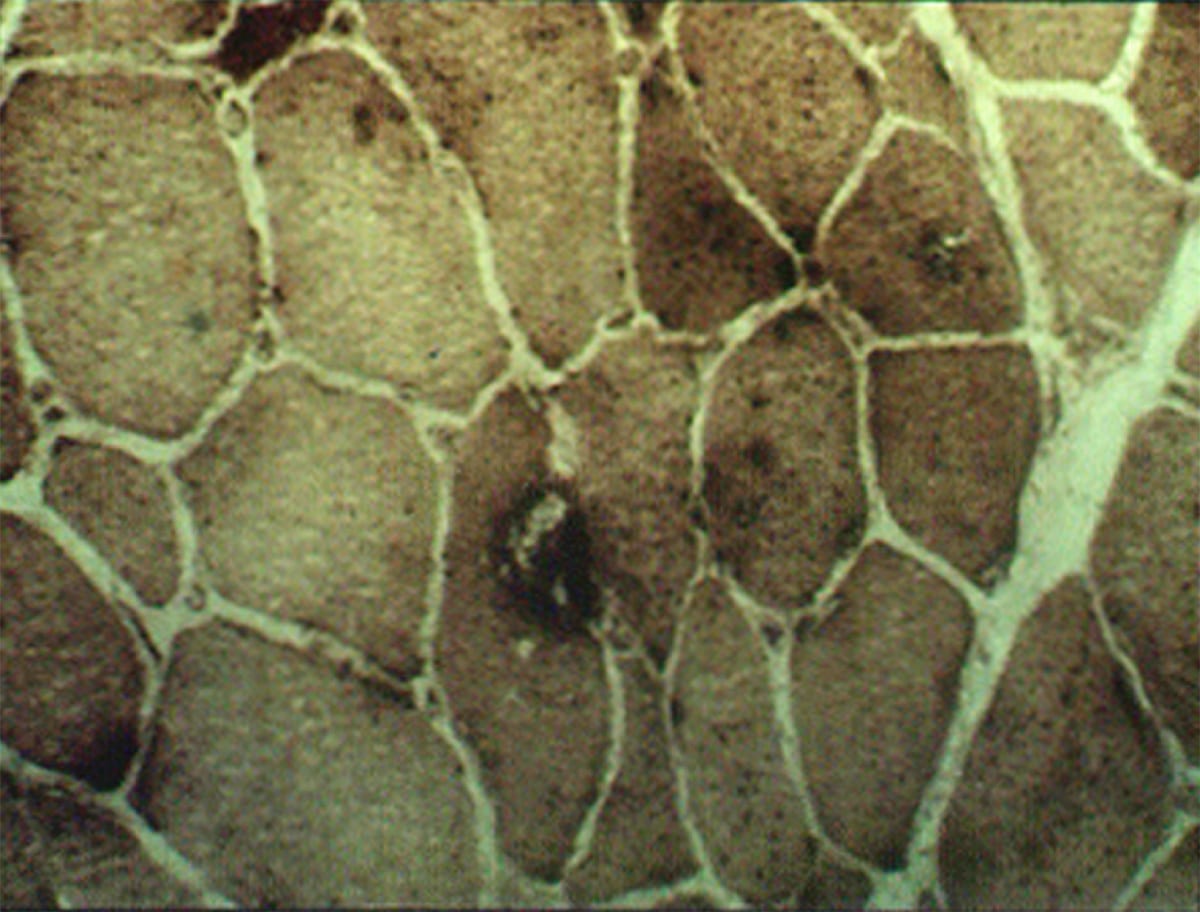 Muscle Pathology Review w/ Images and Quiz! | NowYouKnow Neuro