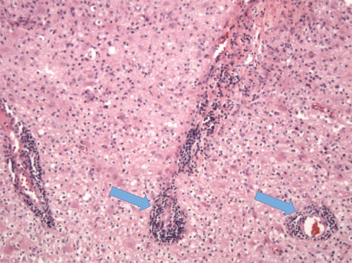 Demyelinating Disease Review and Quiz | NowYouKnow Neuro