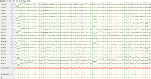 Learn to Read EEG , with practice questions! | NowYouKnow Neuro