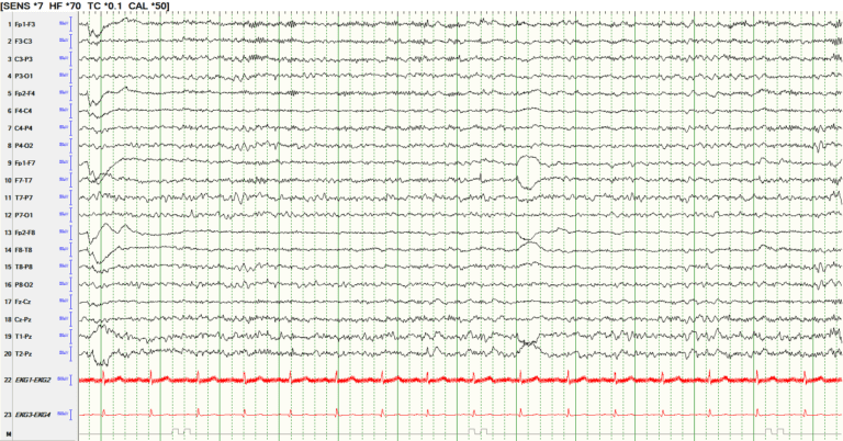 Learn to Read EEG , with practice questions! | NowYouKnow Neuro