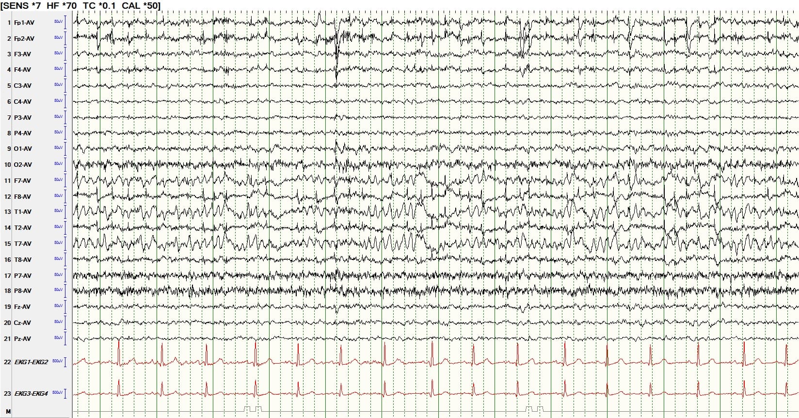 Learn to Read EEG , with practice questions! | NowYouKnow Neuro