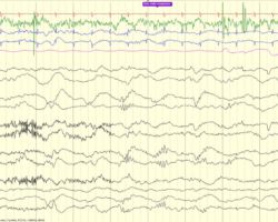 Learn to Read EEG , with practice questions! | NowYouKnow Neuro