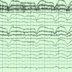 Learn to Read EEG , with practice questions! | NowYouKnow Neuro