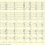 Learn to Read EEG , with practice questions! | NowYouKnow Neuro