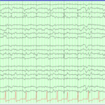 Learn to Read EEG , with practice questions! | NowYouKnow Neuro