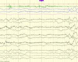 Learn to Read EEG , with practice questions! | NowYouKnow Neuro