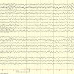 Learn to Read EEG , with practice questions! | NowYouKnow Neuro