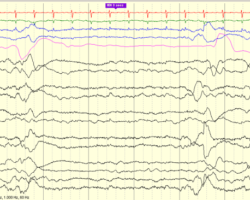 Learn to Read EEG , with practice questions! | NowYouKnow Neuro