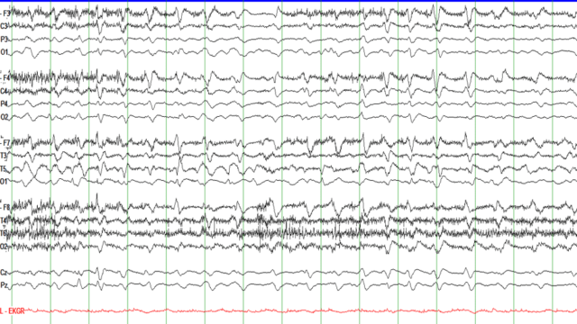Learn to Read EEG , with practice questions! | NowYouKnow Neuro