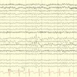 Learn to Read EEG , with practice questions! | NowYouKnow Neuro