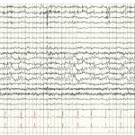 Learn to Read EEG , with practice questions! | NowYouKnow Neuro