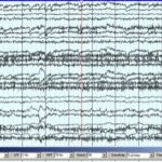 Learn to Read EEG , with practice questions! | NowYouKnow Neuro