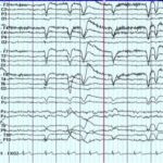 Learn to Read EEG , with practice questions! | NowYouKnow Neuro