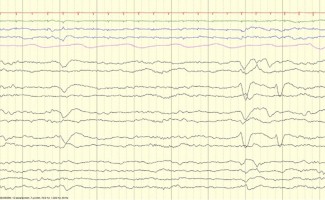 How to Read EEG Practice | Exam Prep | NowYouKnow Neuro