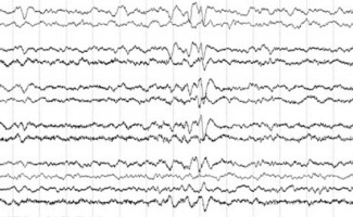 How to Read EEG Practice | Exam Prep | NowYouKnow Neuro