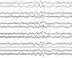 Learn to Read EEG , with practice questions! | NowYouKnow Neuro