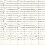 Learn to Read EEG , with practice questions! | NowYouKnow Neuro