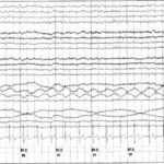 Learn to Read EEG , with practice questions! | NowYouKnow Neuro