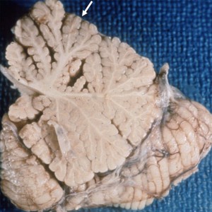 High Yield Neuropathology - Over 200 Images! | NowYouKnow Neuro