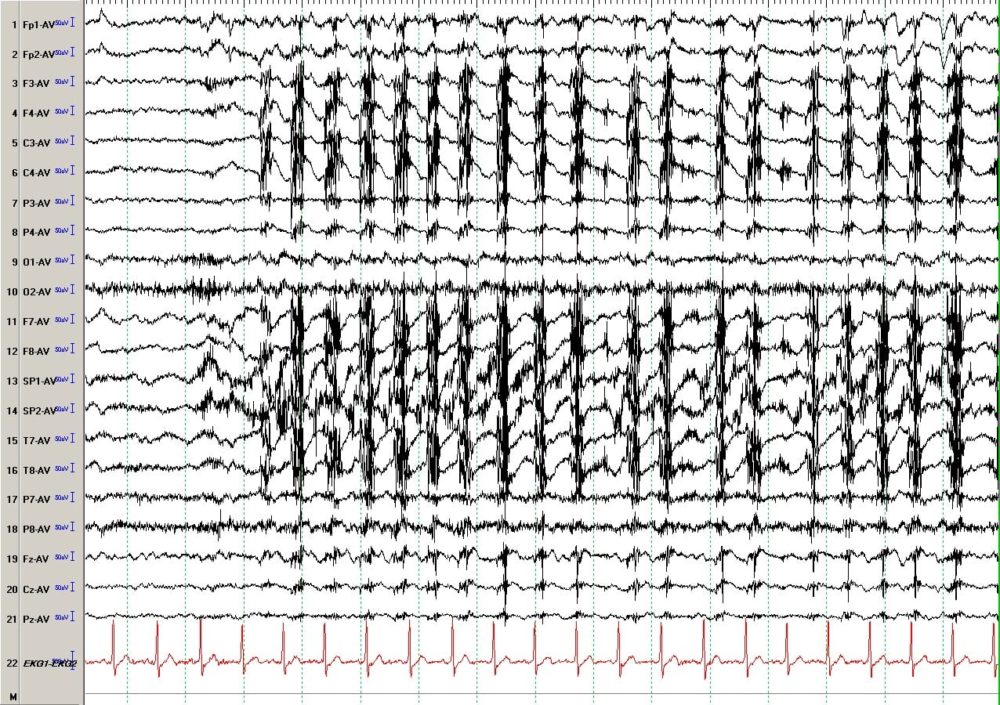 eeg baseline | NowYouKnow Neuro