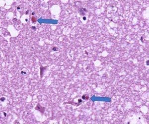 Neuroinfectious Disease Review and Practice Quiz | NowYouKnow Neuro