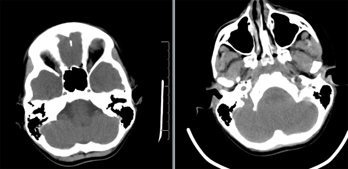 High Yield Neuroradiology - Over 200 Images! | NowYouKnow Neuro