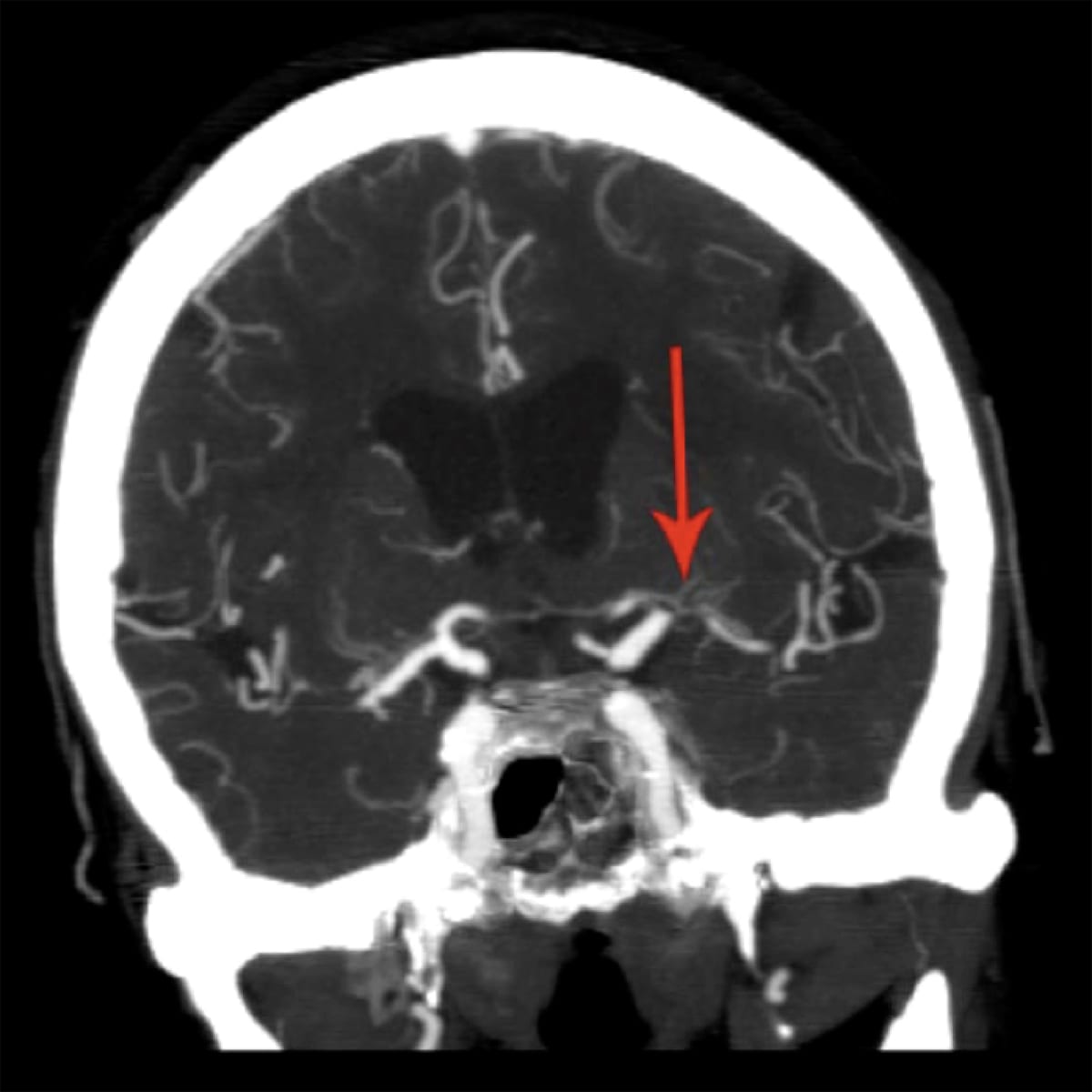 High Yield Neuroradiology - Over 200 Images! | NowYouKnow Neuro